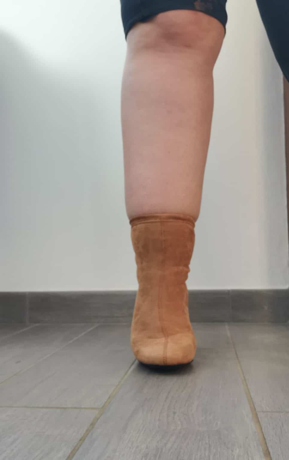 Le lipoedème des jambes : témoignages - Lipolab